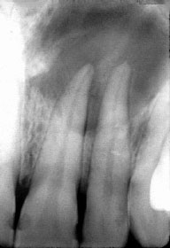HomesteadSchools.com - Cysts of the Jaws