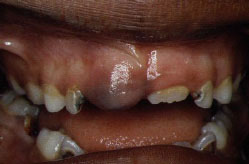 HomesteadSchools.com - Cysts of the Jaws